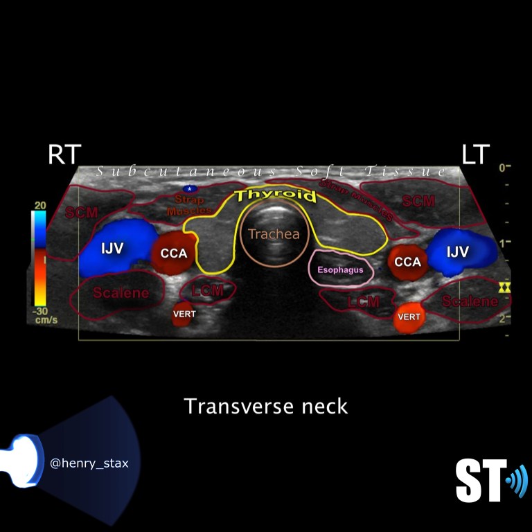 Thyroid Ultrasound Protocol – Sonographic Tendencies