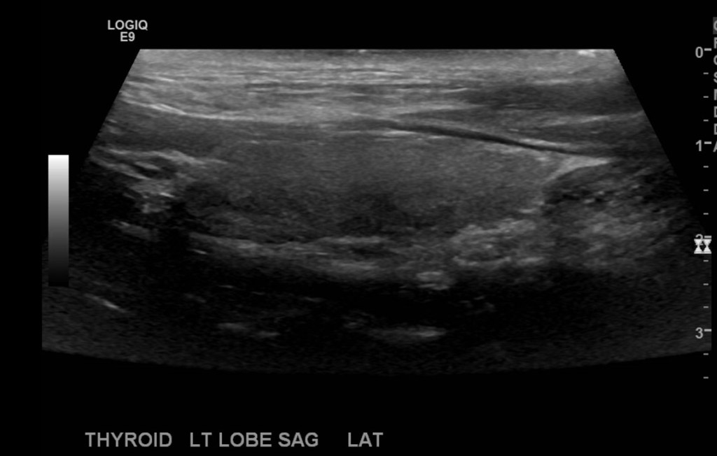 Thyroid Ultrasound Protocol – Sonographic Tendencies
