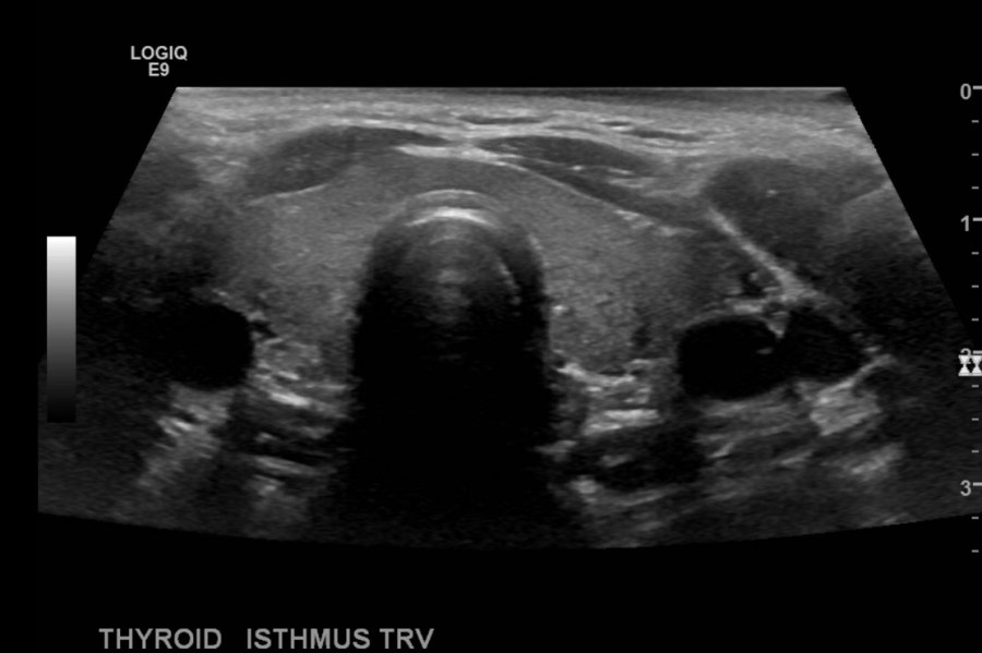 Thyroid Ultrasound Protocol – Sonographic Tendencies
