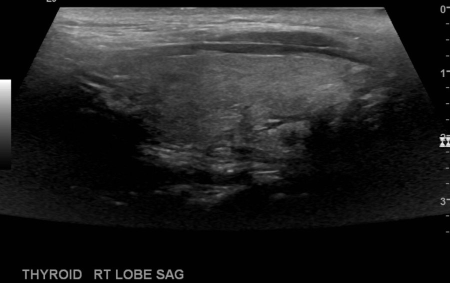 Thyroid Ultrasound Protocol – Sonographic Tendencies