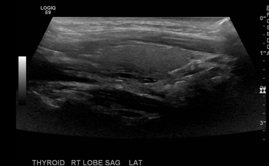 Thyroid Ultrasound Protocol – Sonographic Tendencies