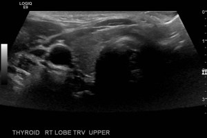 Thyroid Ultrasound Protocol – Sonographic Tendencies