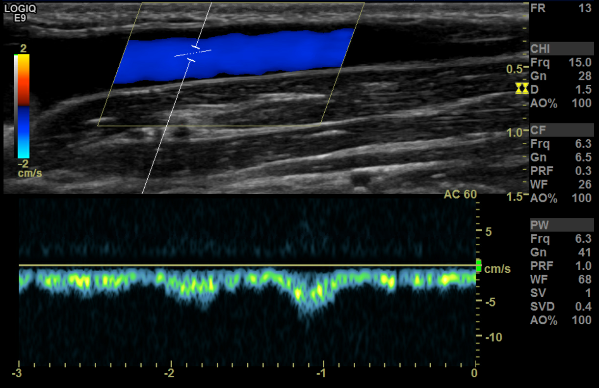 Hemodialysis Vascular Access – Sonographic Tendencies