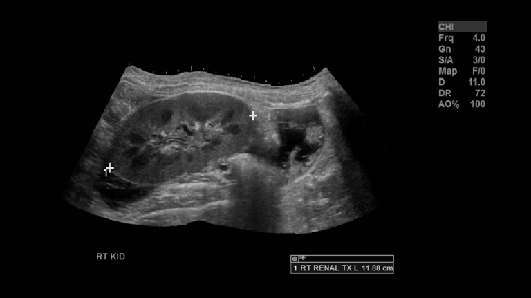 Renal Transplant Duplex Protocol – Sonographic Tendencies