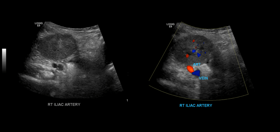 Renal Transplant Duplex Protocol – Sonographic Tendencies