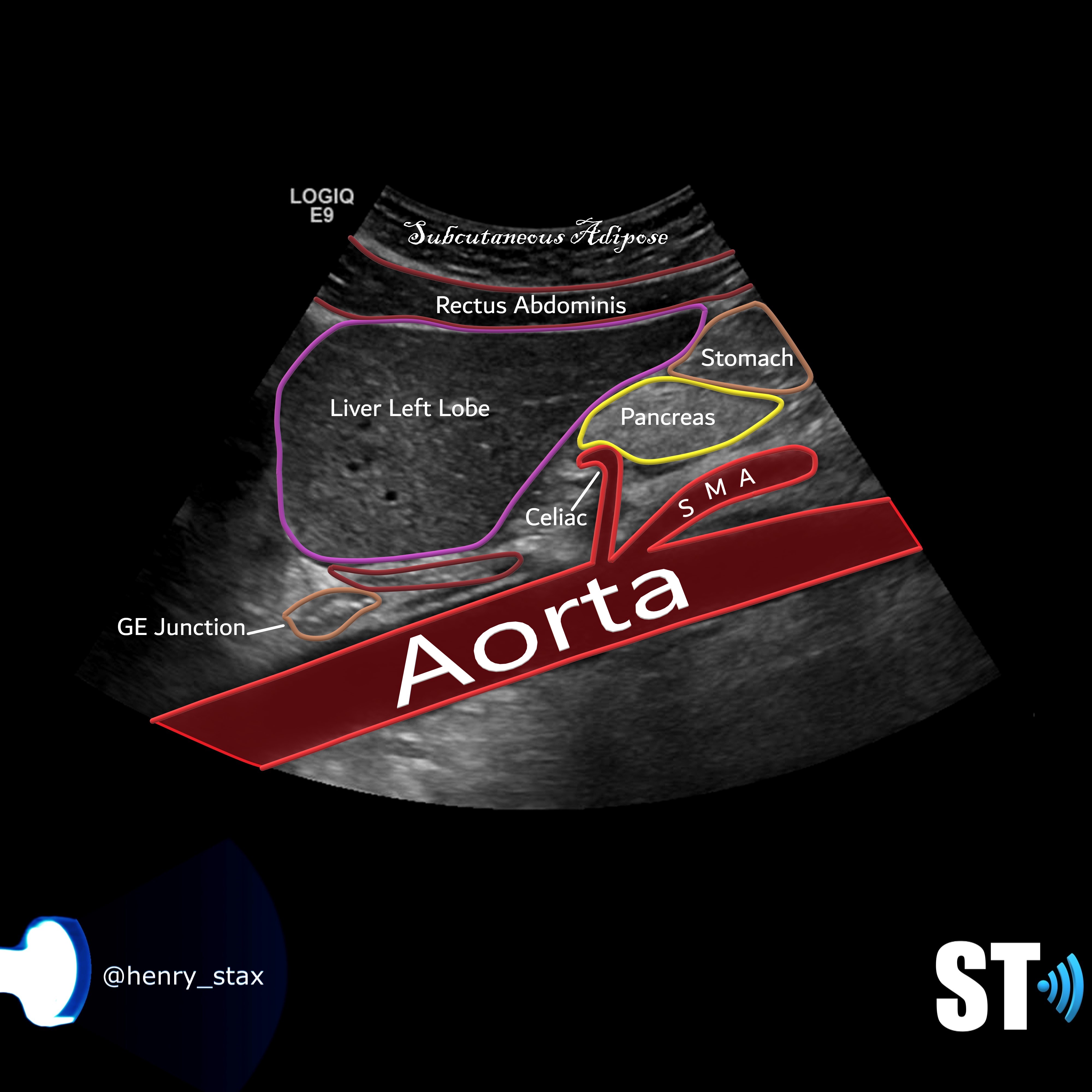 Aorta Duplex/Doppler Protocol – Sonographic Tendencies