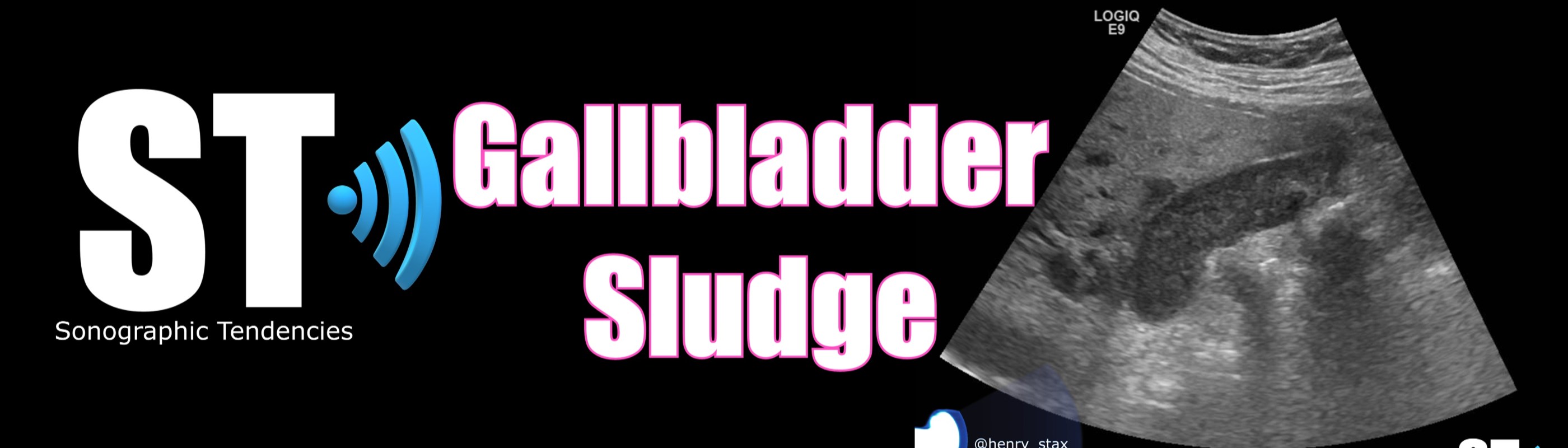 Gallbladder Sludge – Sonographic Tendencies