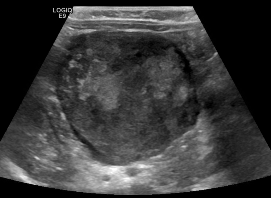 Neuroblastoma – Sonographic Tendencies
