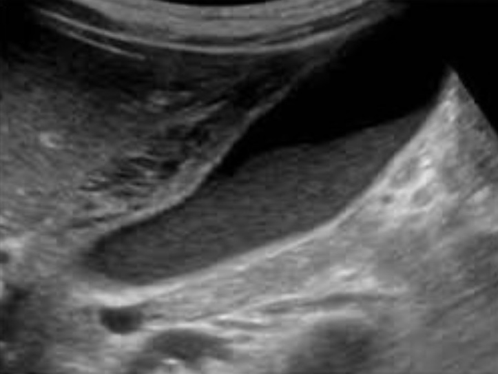 Gallbladder Sludge – Sonographic Tendencies