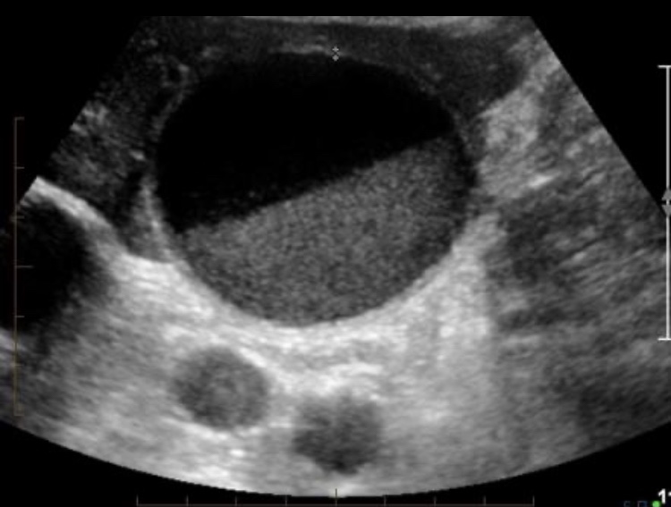 Gallbladder Sludge – Sonographic Tendencies