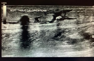 Venous Insufficiency Case/Protocol – Sonographic Tendencies