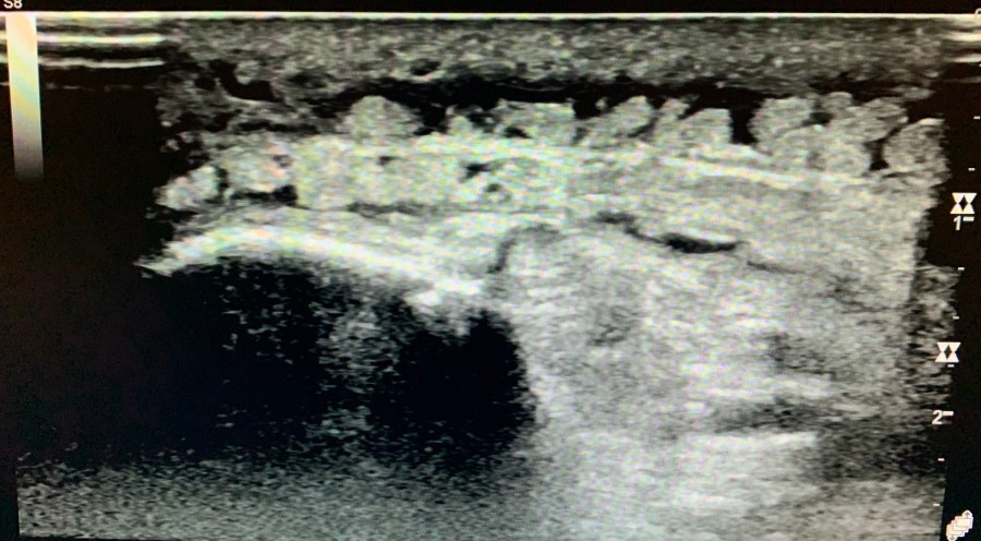 Venous Insufficiency Case/Protocol – Sonographic Tendencies