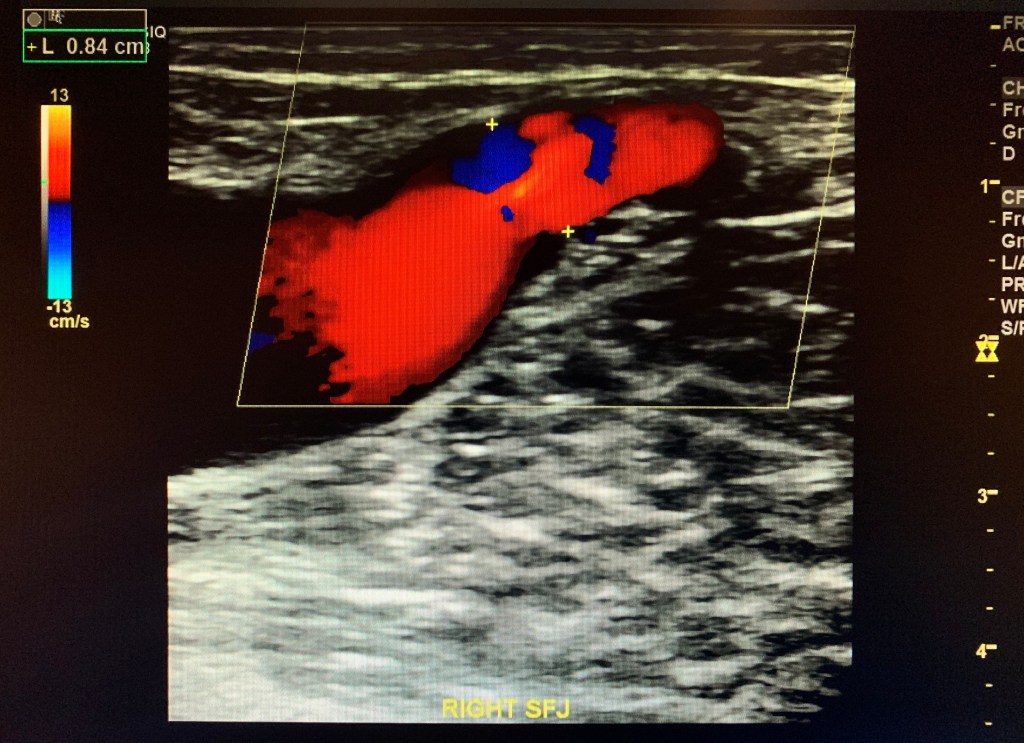 Venous Insufficiency Case/Protocol – Sonographic Tendencies