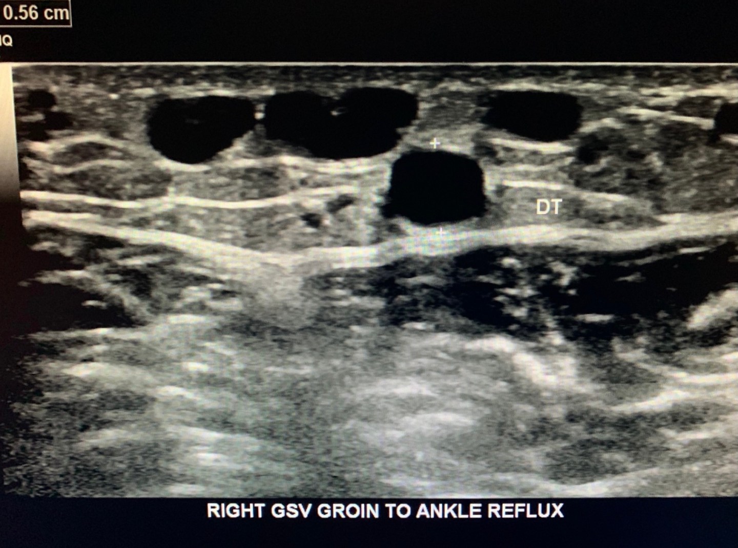Venous Insufficiency Case/Protocol – Sonographic Tendencies