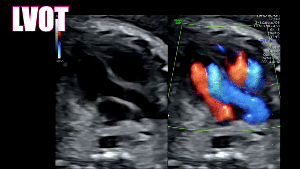 Fetal Heart Survey – Sonographic Tendencies