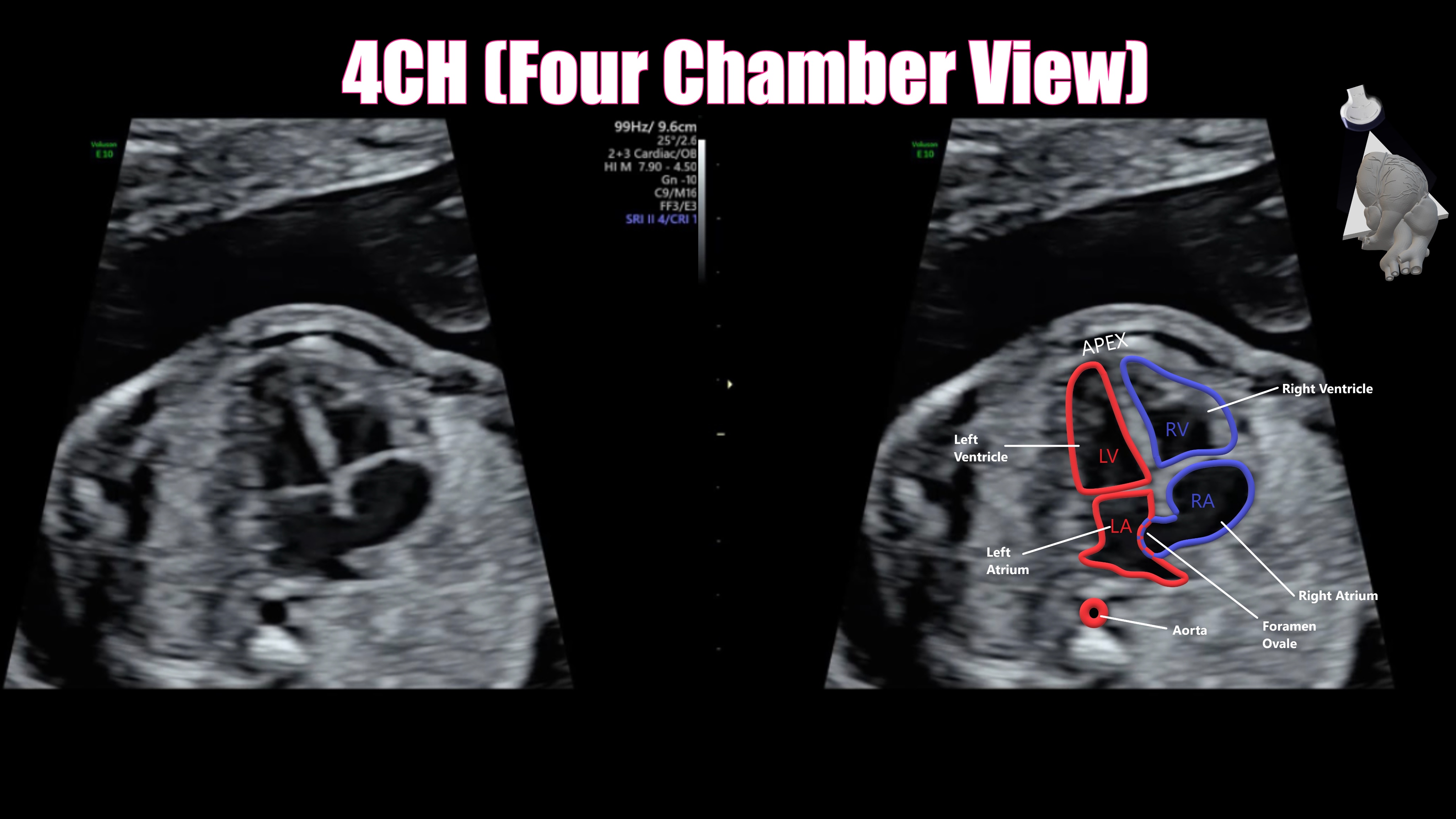 Fetal Heart Survey Sonographic Tendencies