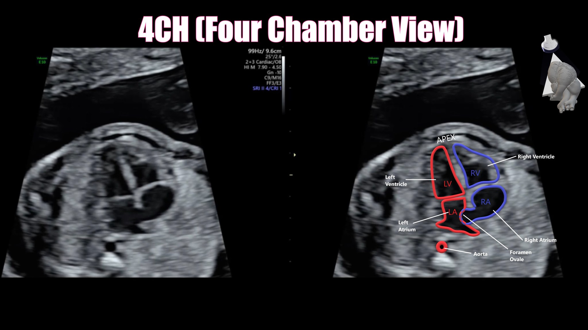 Fetal Heart Survey – Sonographic Tendencies