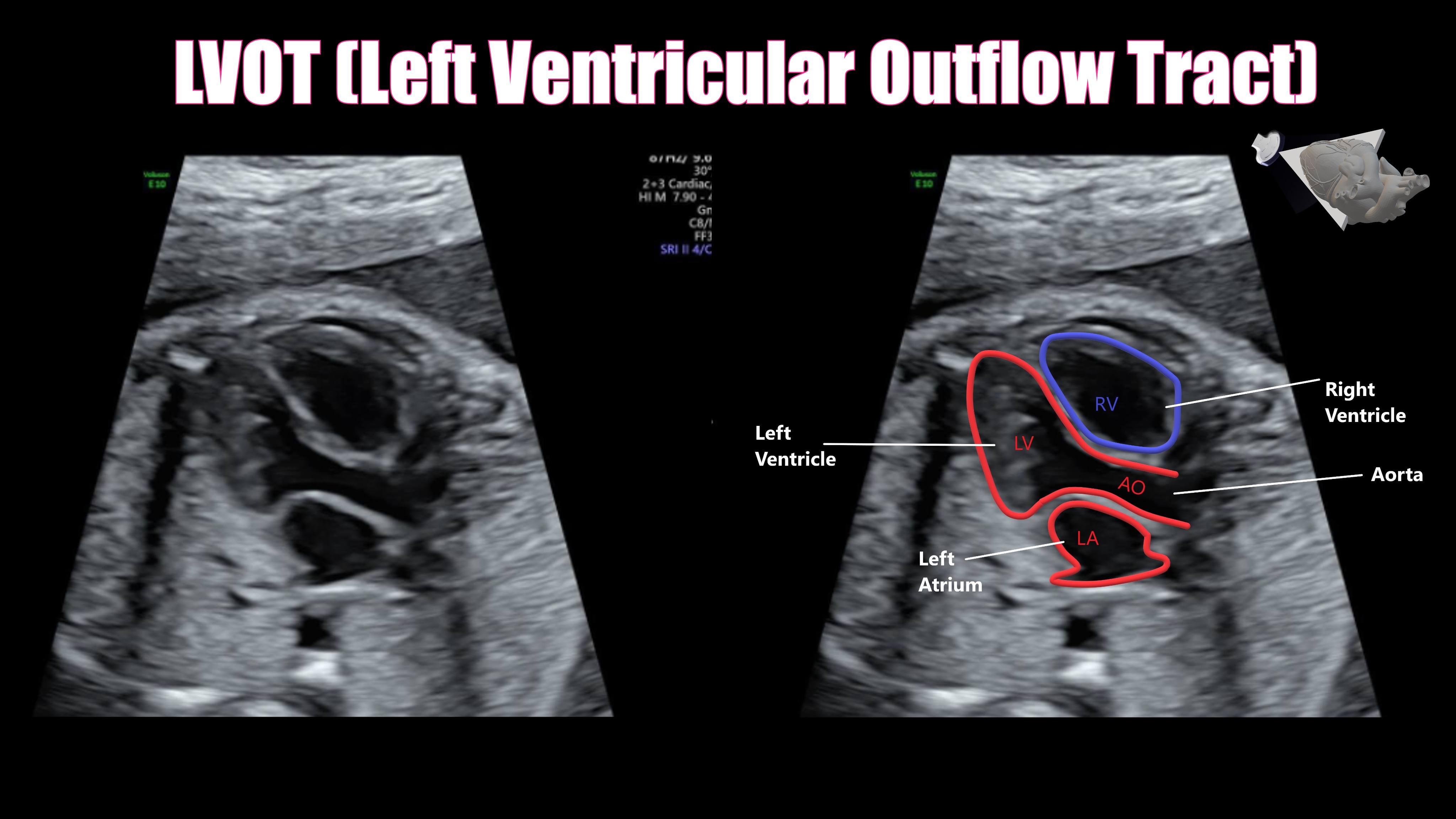 Fetal Heart Survey – Sonographic Tendencies