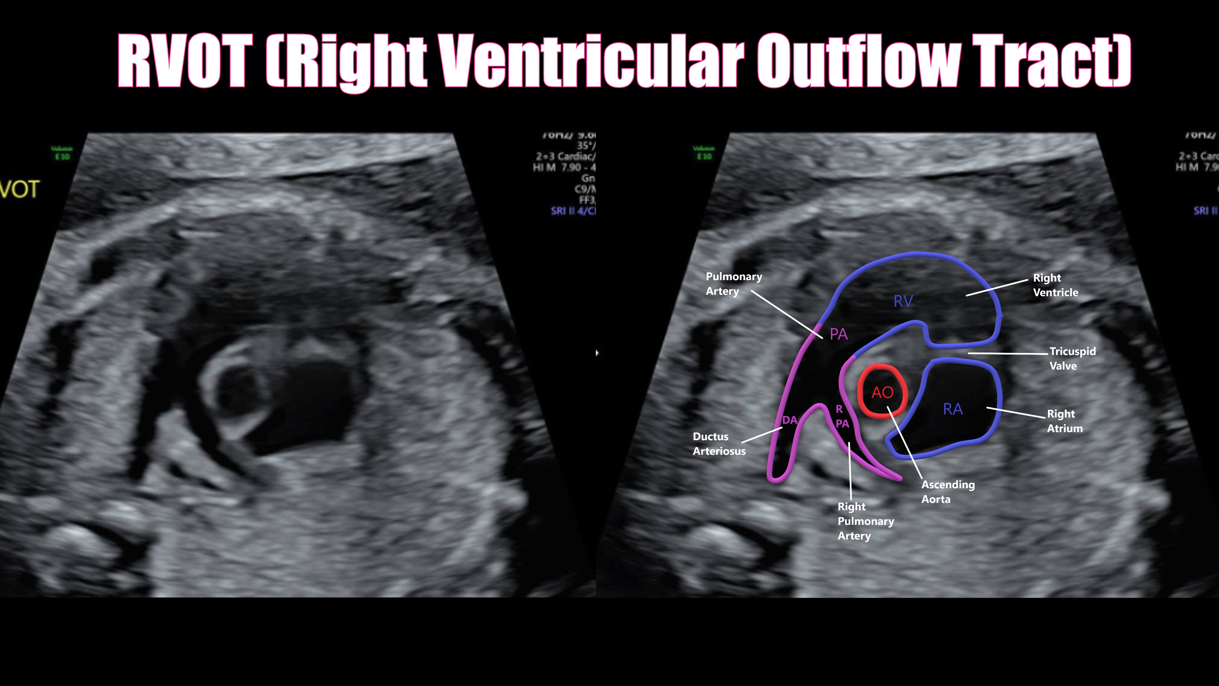Fetal Heart Survey – Sonographic Tendencies
