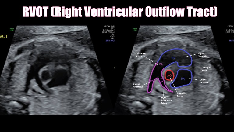 Fetal Heart Survey – Sonographic Tendencies