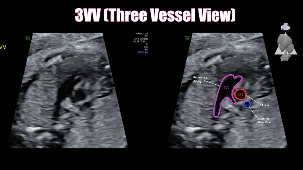 Fetal Heart Survey – Sonographic Tendencies