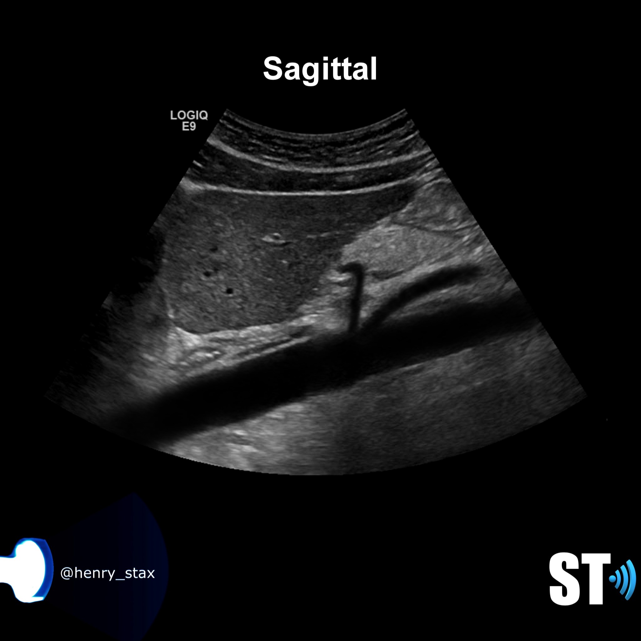 Nutcracker Phenomenon/Syndrome – Sonographic Tendencies