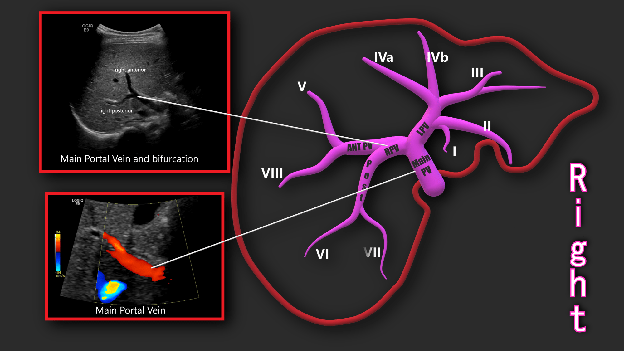 Portal Vein Doppler – Sonographic Tendencies