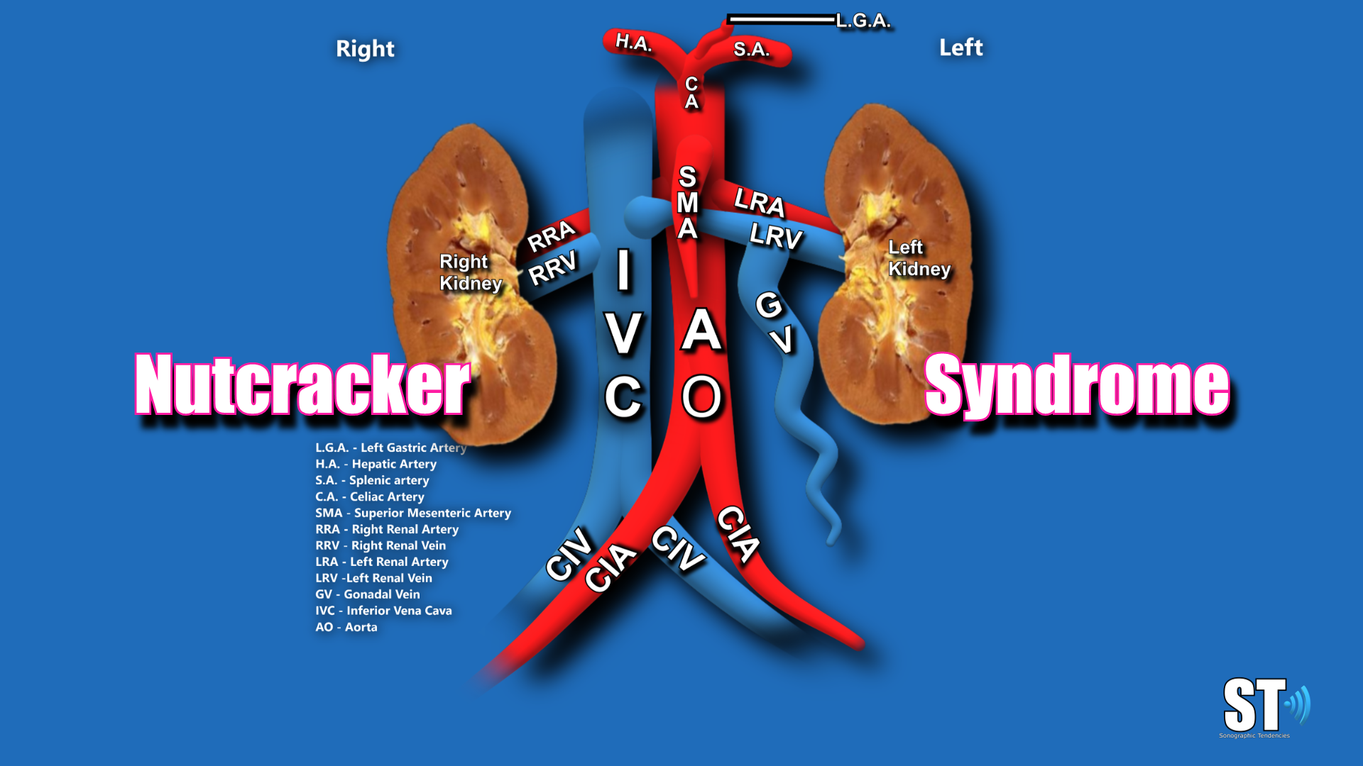 Nutcracker Phenomenon/Syndrome – Sonographic Tendencies