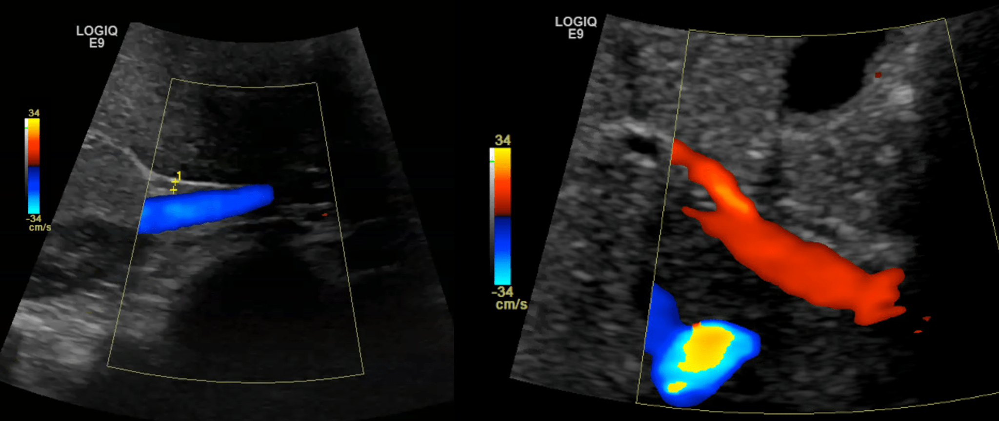 Portal Vein Doppler – Sonographic Tendencies