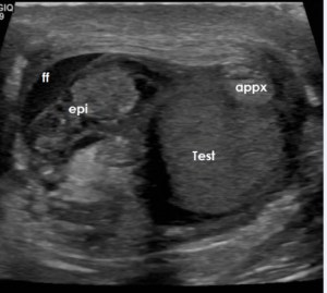 Torsed Appendix Testis – Sonographic Tendencies