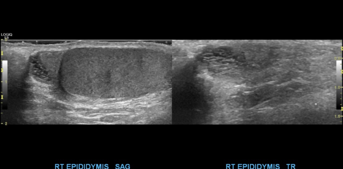 Torsed Appendix Testis – Sonographic Tendencies