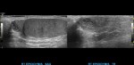 Torsed Appendix Testis – Sonographic Tendencies