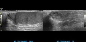 Torsed Appendix Testis – Sonographic Tendencies