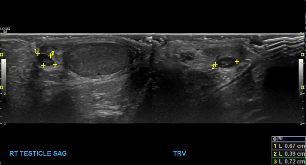 Torsed Appendix Testis – Sonographic Tendencies