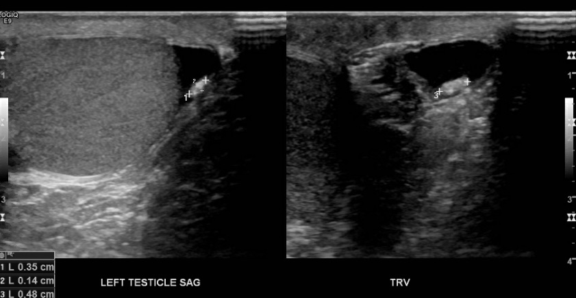 Torsed Appendix Testis – Sonographic Tendencies