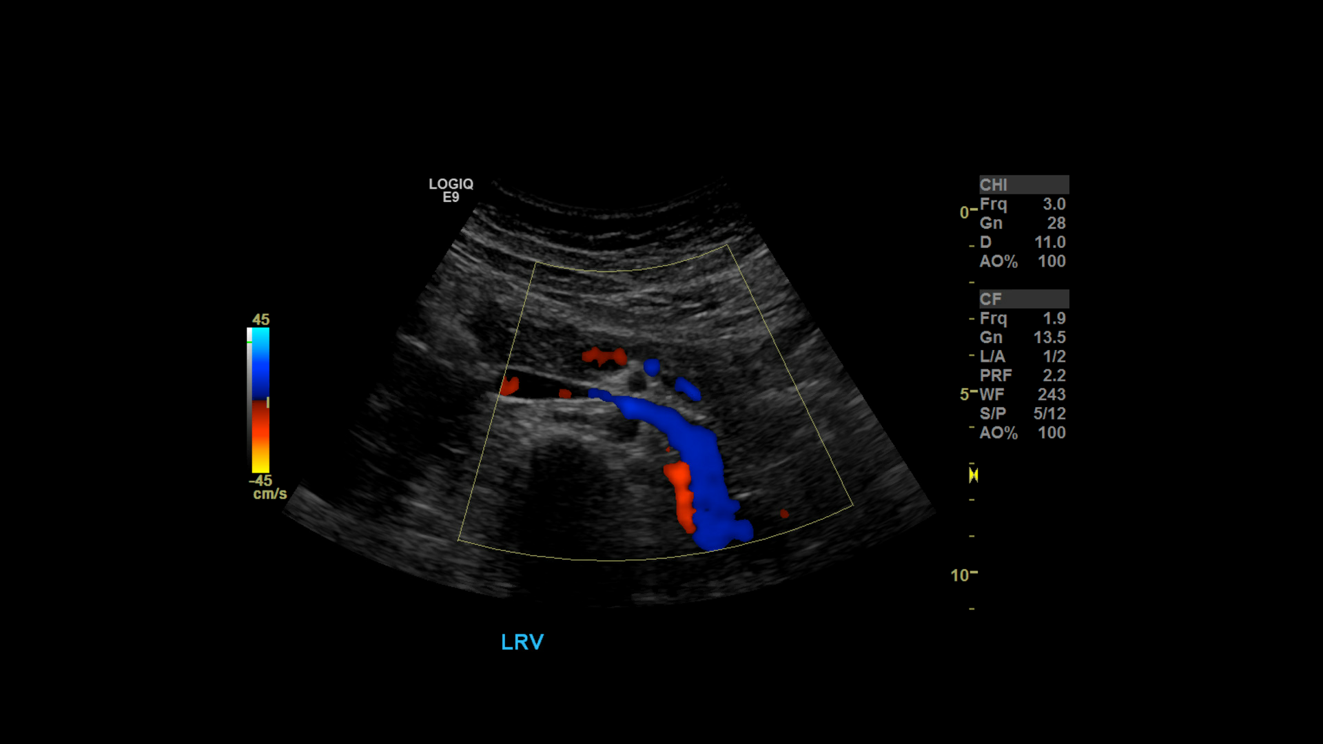 Nutcracker Phenomenon/Syndrome – Sonographic Tendencies