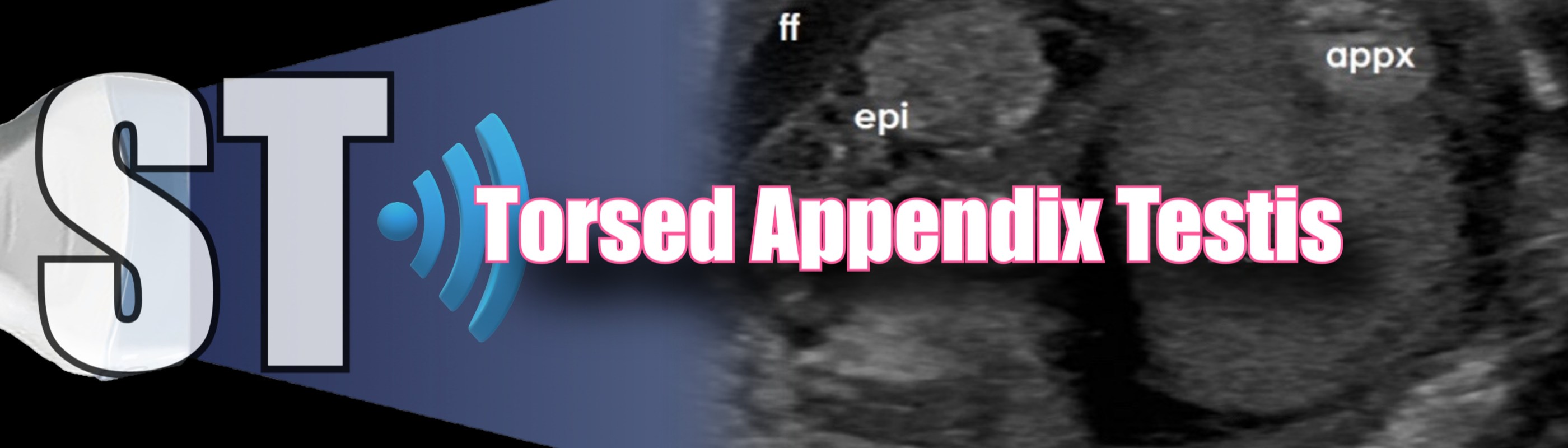 Torsed Appendix Testis – Sonographic Tendencies