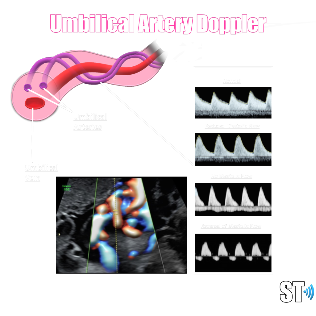 Umbilical Artery Doppler – Sonographic Tendencies