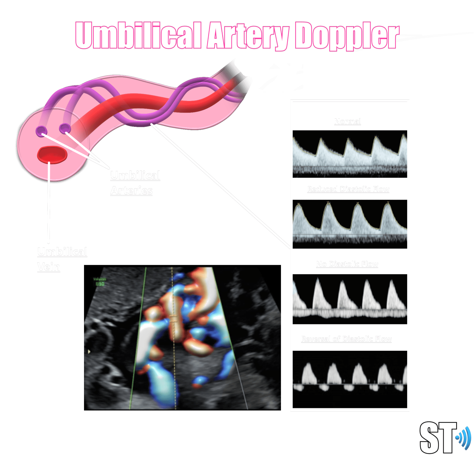 Umbilical Artery Doppler – Sonographic Tendencies