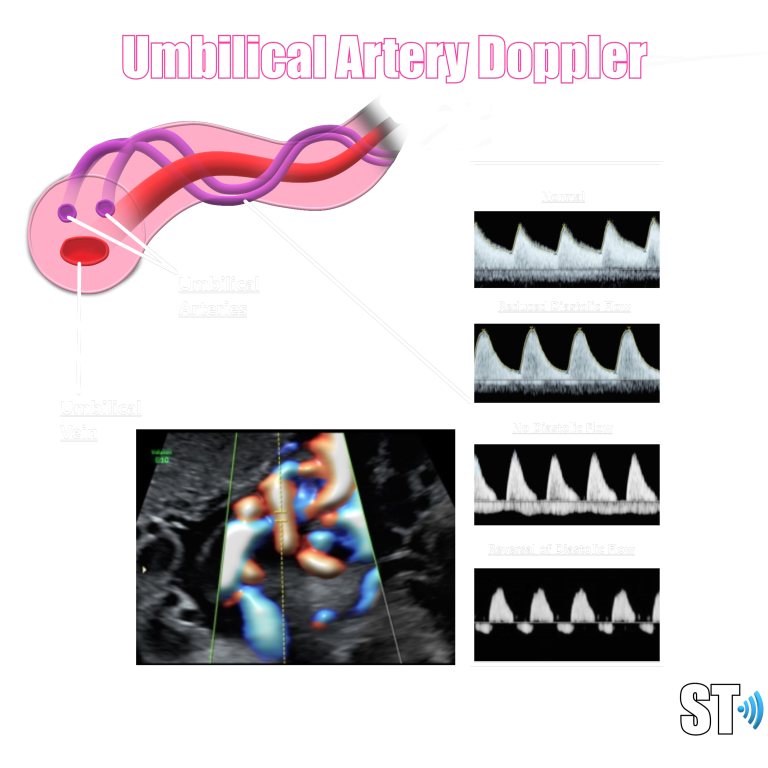 Umbilical Artery Doppler – Sonographic Tendencies