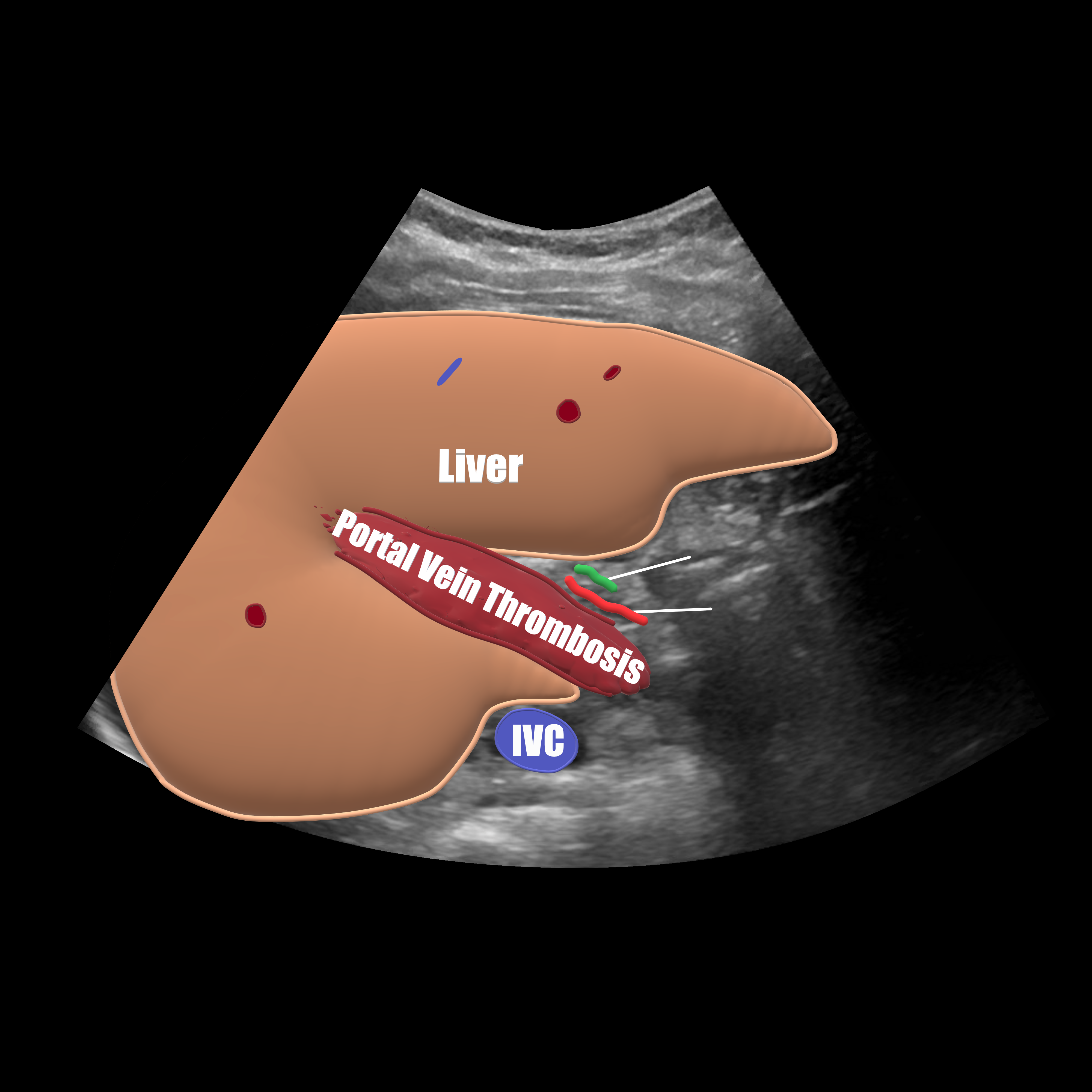 Portal Vein Doppler – Sonographic Tendencies