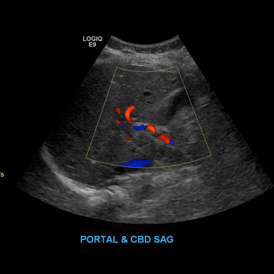 Portal Vein Doppler – Sonographic Tendencies