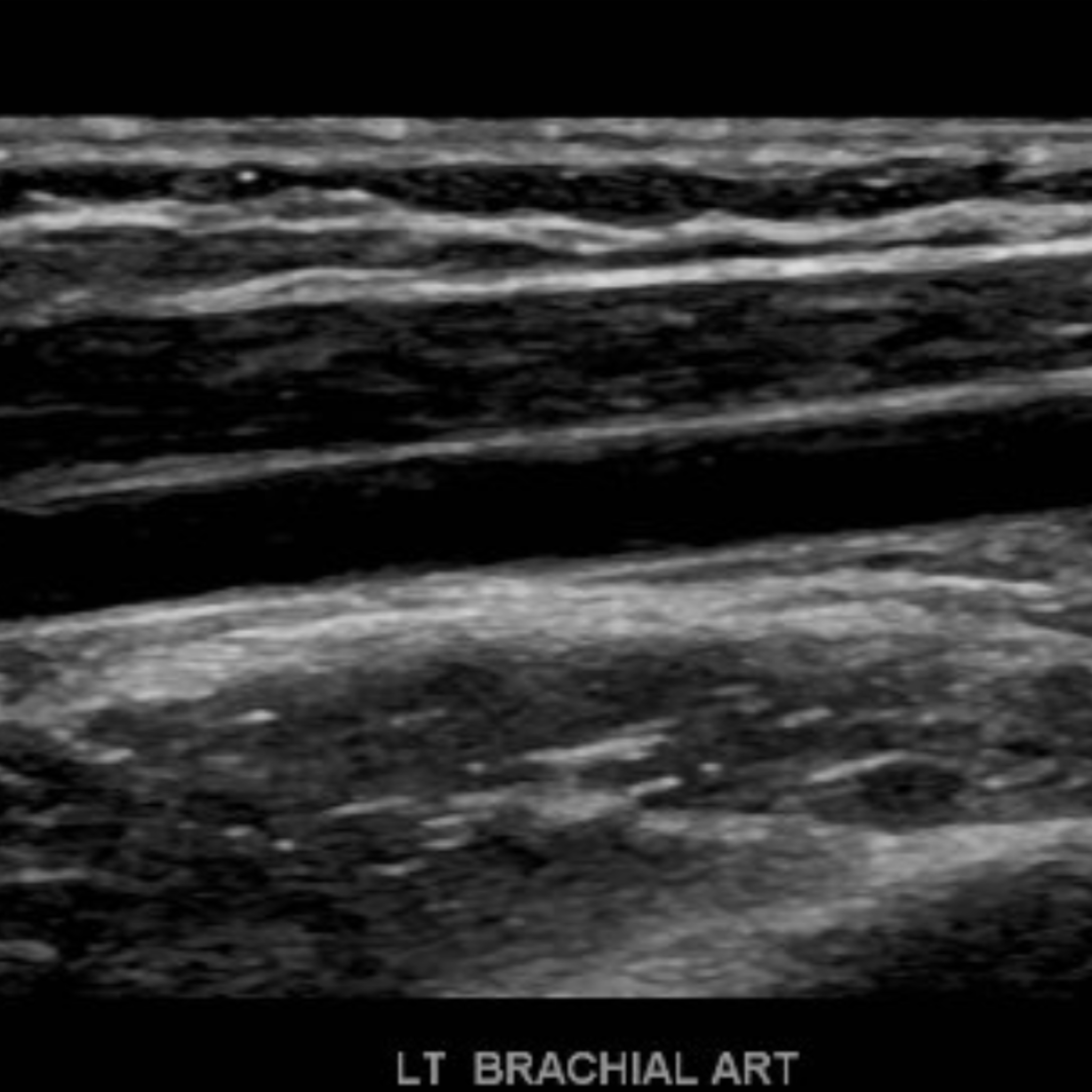 Arterial Duplex/Doppler Sonography of the Upper Extremities ...