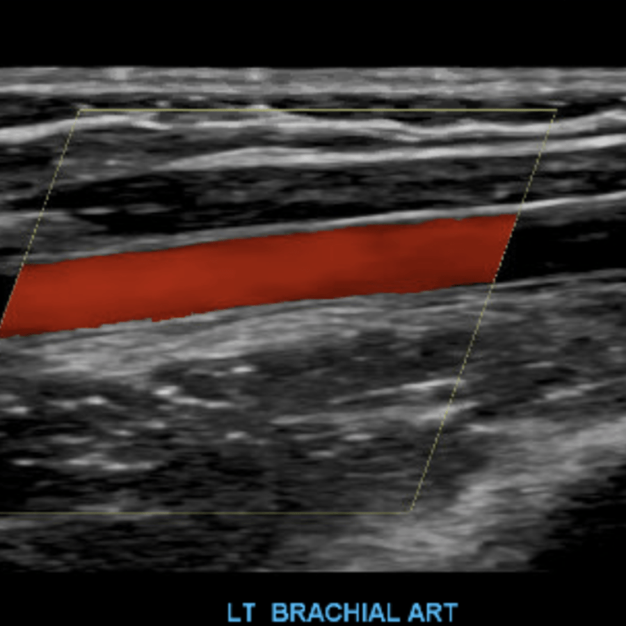 Arterial Duplex/Doppler Sonography of the Upper Extremities ...