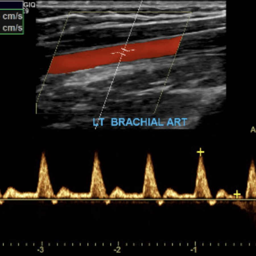 Arterial Duplex/Doppler Sonography of the Upper Extremities ...