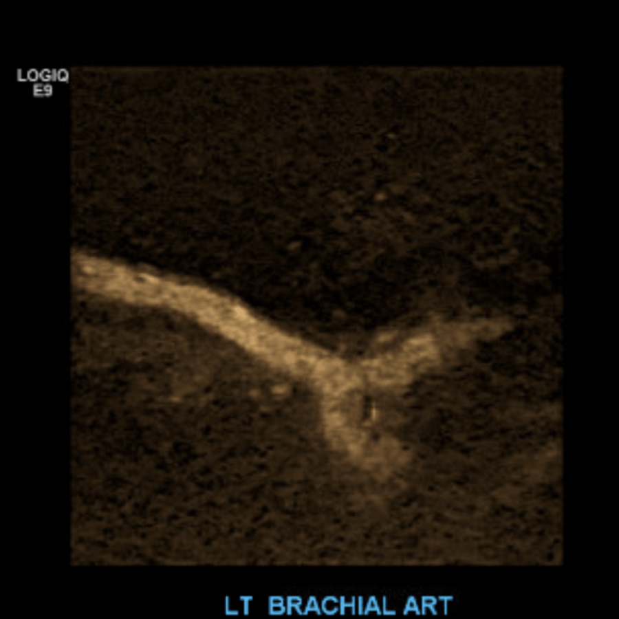 Arterial Duplex/Doppler Sonography of the Upper Extremities ...
