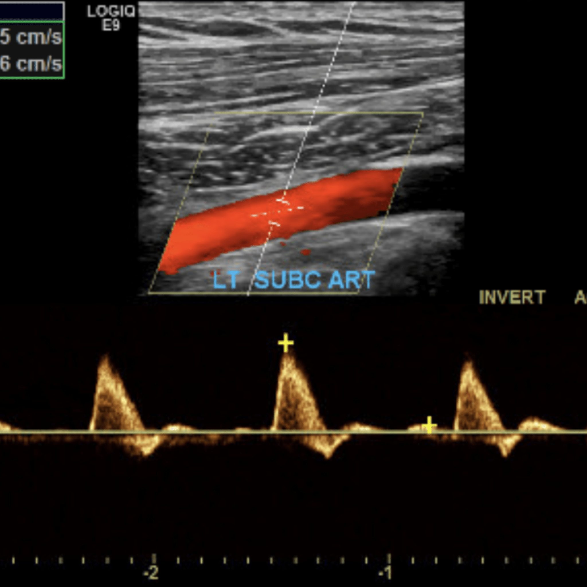 Arterial Duplex/Doppler Sonography of the Upper Extremities ...