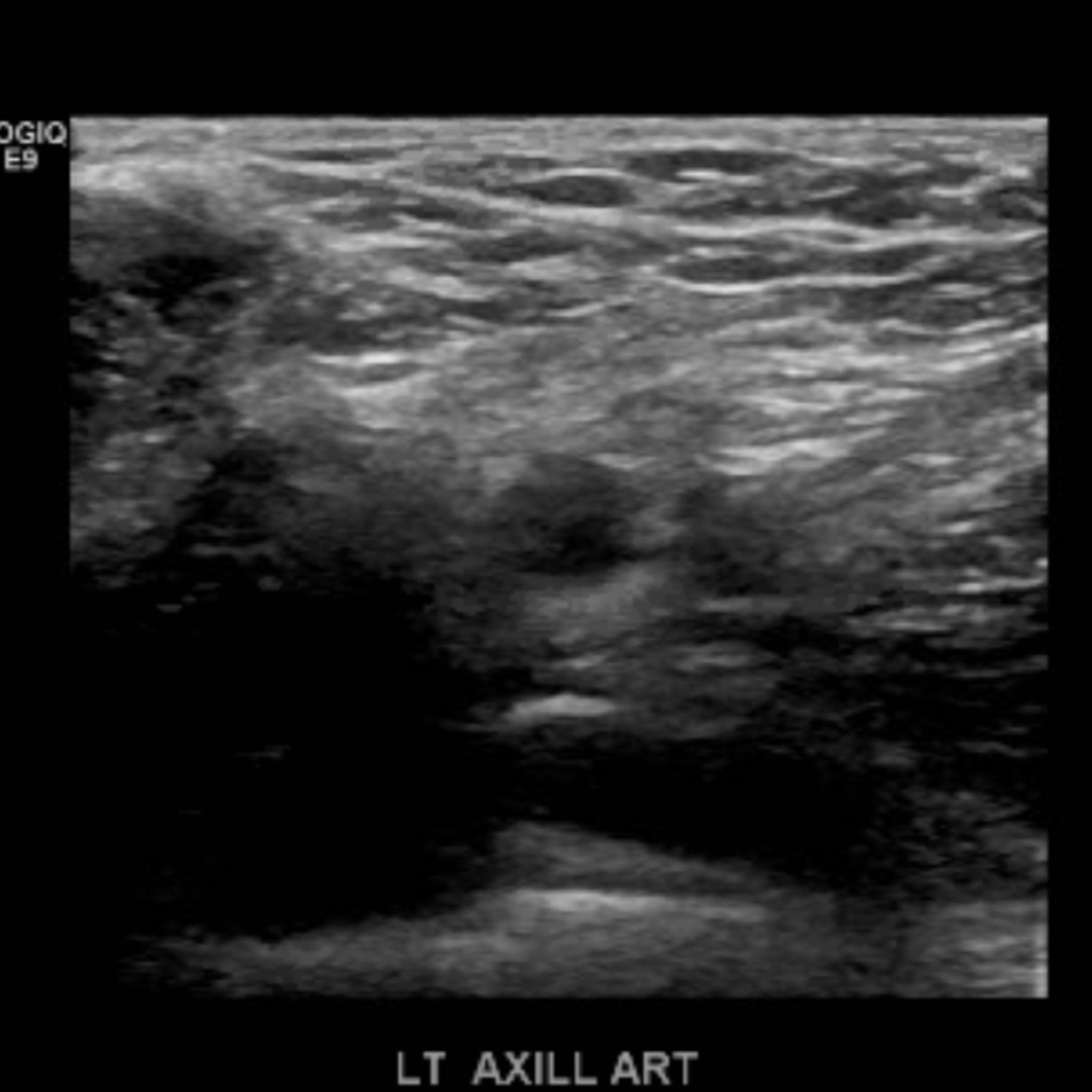 Arterial Duplex/Doppler Sonography of the Upper Extremities ...