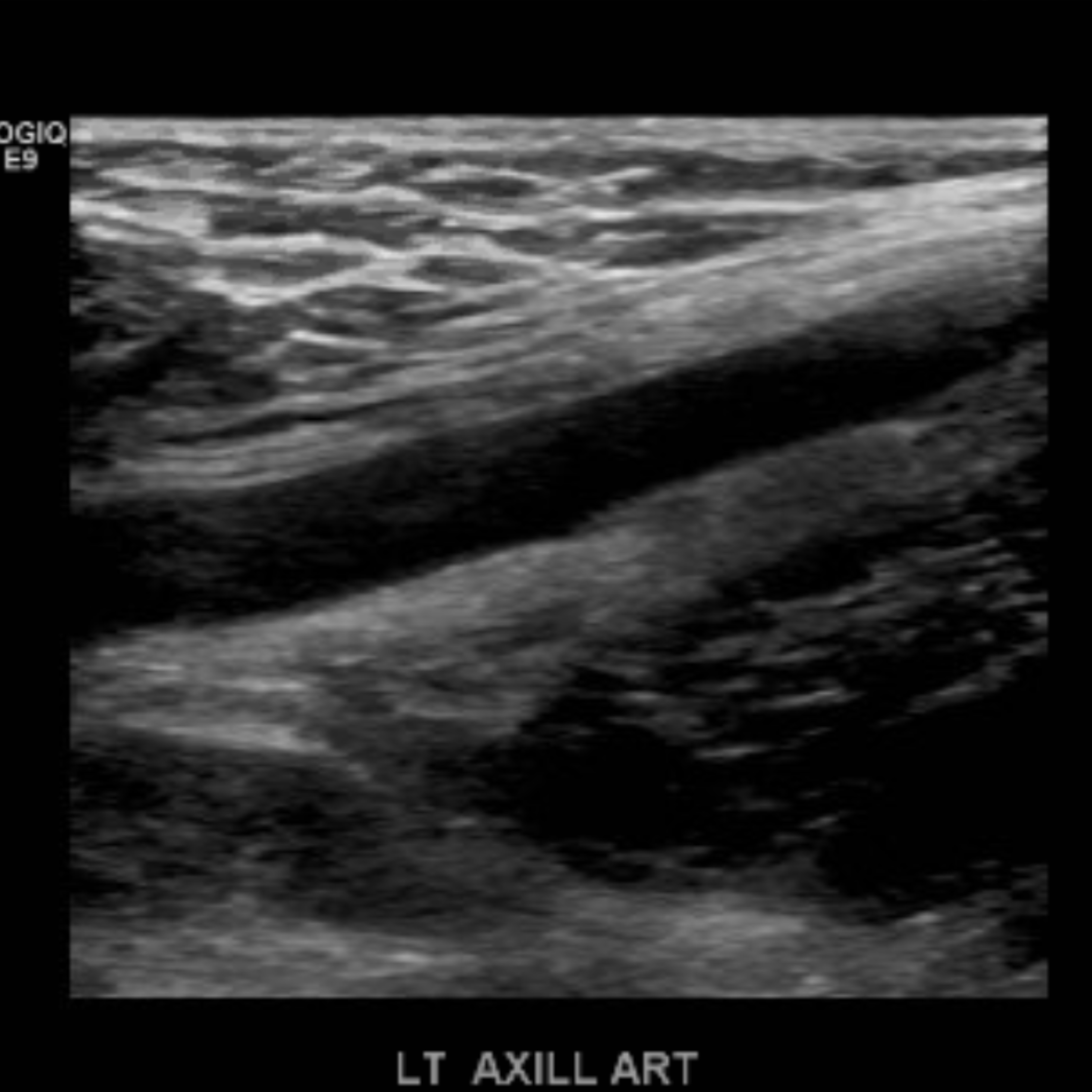 Arterial Duplex/Doppler Sonography of the Upper Extremities ...