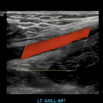 Arterial Duplex/Doppler Sonography of the Upper Extremities ...